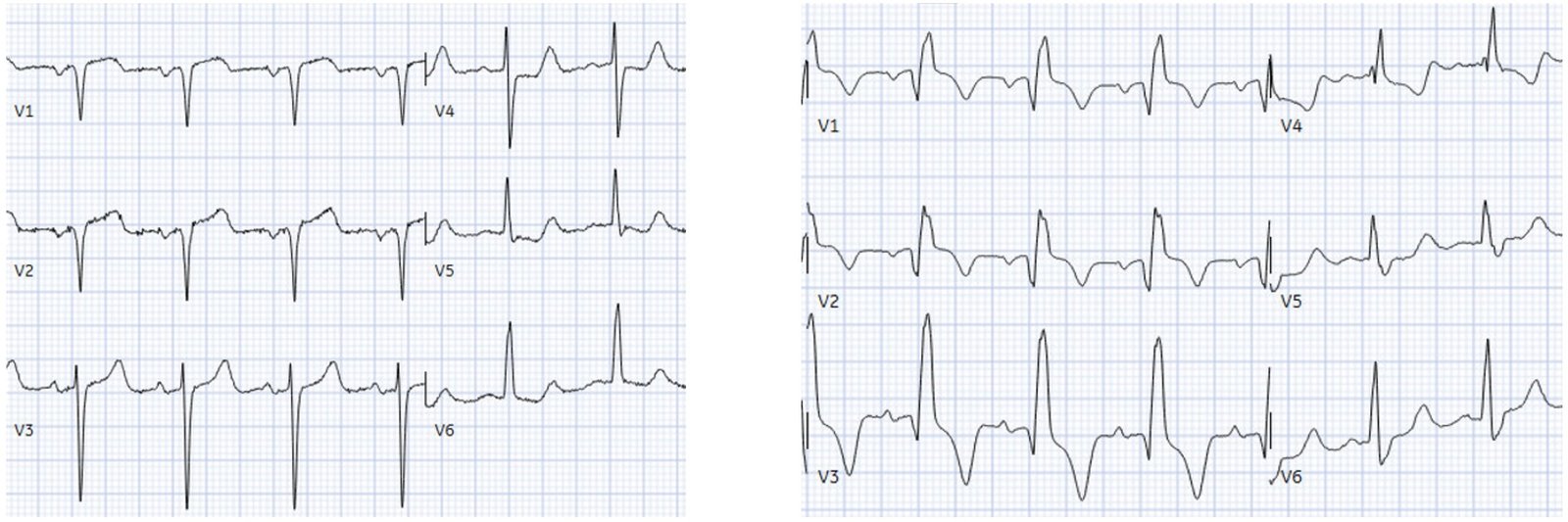 Chest pain with acute RBBB: just another NSTEMI? - Dr. Smith’s ECG Blog