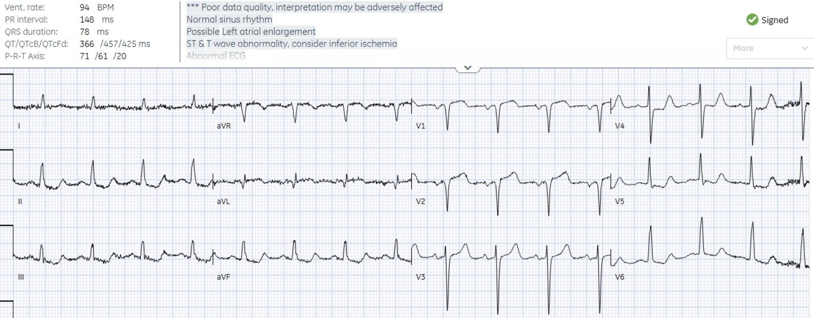Chest pain with acute RBBB: just another NSTEMI? - Dr. Smith’s ECG Blog