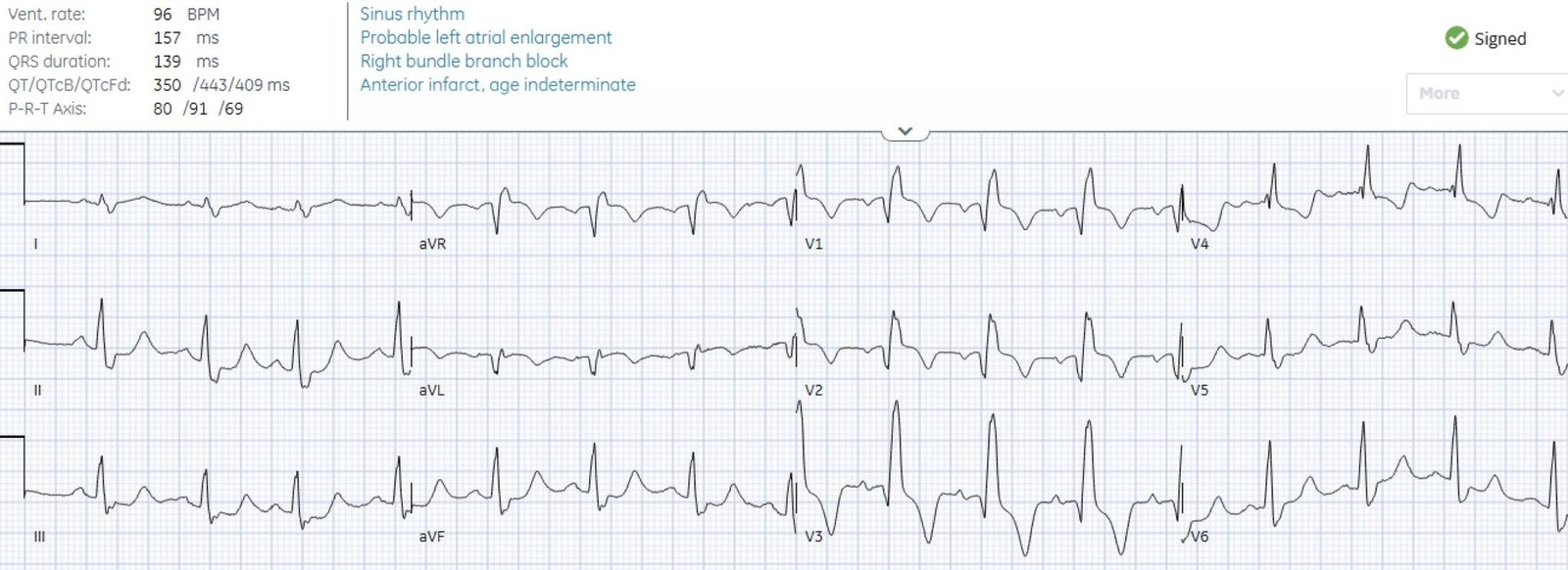 Chest pain with acute RBBB: just another NSTEMI? - Dr. Smith’s ECG Blog