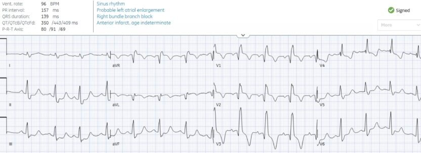 Chest pain with acute RBBB: just another NSTEMI? - Dr. Smith’s ECG Blog