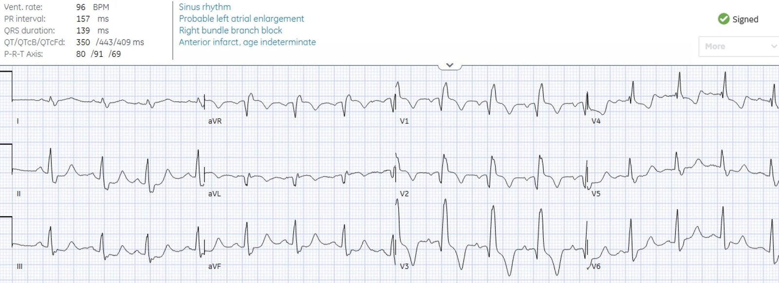 Chest pain with acute RBBB: just another NSTEMI? - Dr. Smith’s ECG Blog