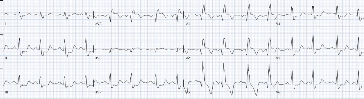Chest pain with acute RBBB: just another NSTEMI? - Dr. Smith’s ECG Blog