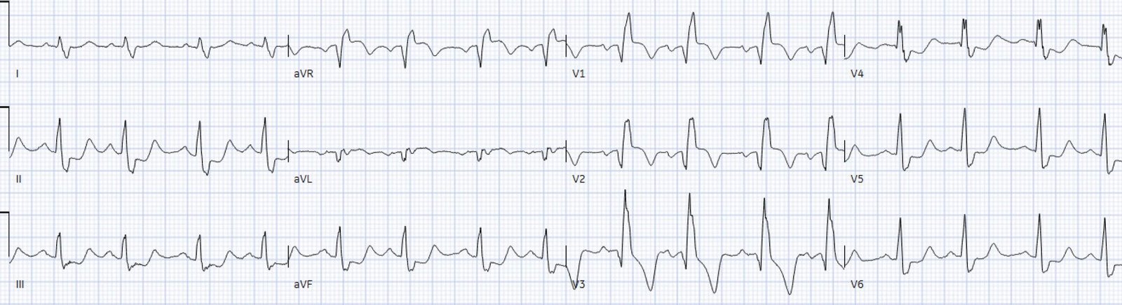 Chest pain with acute RBBB: just another NSTEMI? - Dr. Smith’s ECG Blog