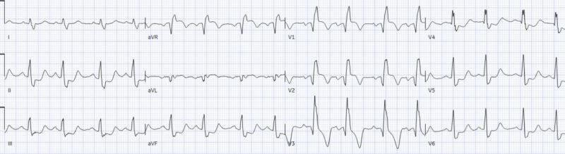Chest pain with acute RBBB: just another NSTEMI? - Dr. Smith’s ECG Blog