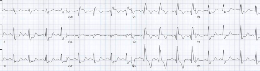 Chest pain with acute RBBB: just another NSTEMI? - Dr. Smith’s ECG Blog