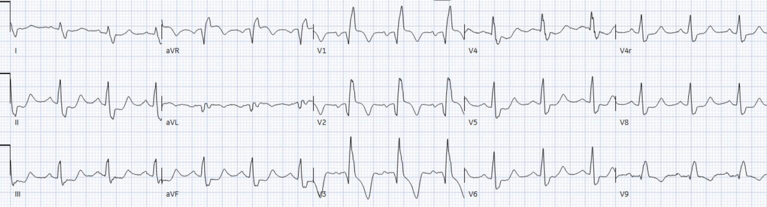 Chest pain with acute RBBB: just another NSTEMI? - Dr. Smith’s ECG Blog