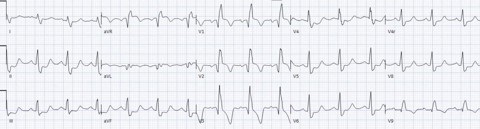 Chest pain with acute RBBB: just another NSTEMI? - Dr. Smith’s ECG Blog