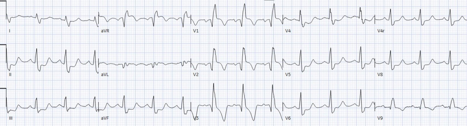 Chest pain with acute RBBB: just another NSTEMI? - Dr. Smith’s ECG Blog