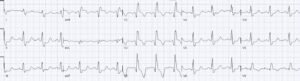 Chest pain with acute RBBB: just another NSTEMI? - Dr. Smith’s ECG Blog