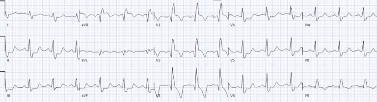Chest pain with acute RBBB: just another NSTEMI? - Dr. Smith’s ECG Blog