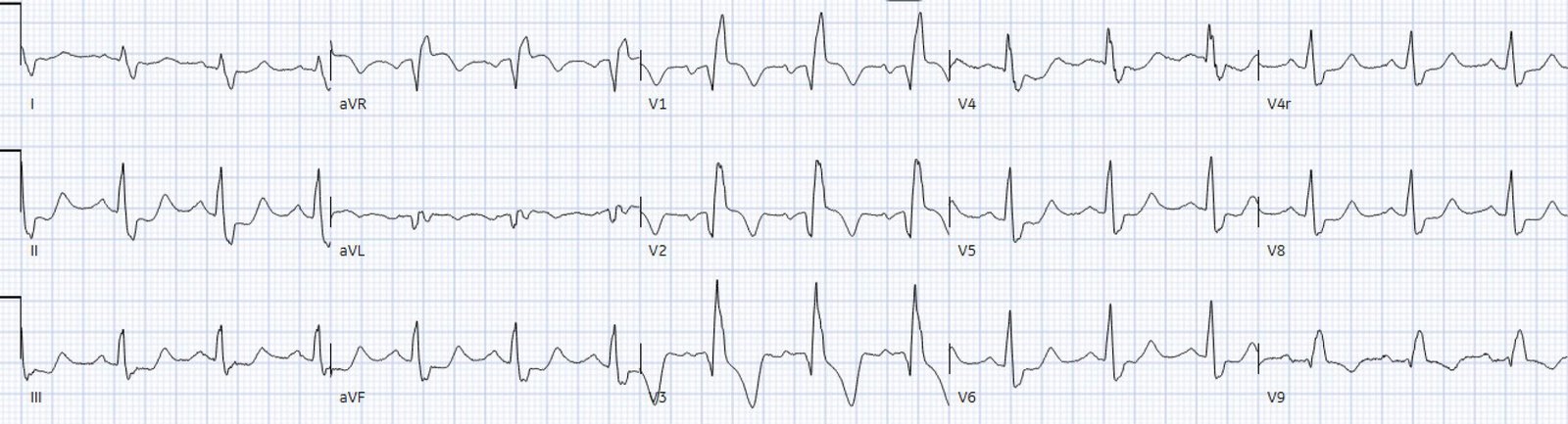 Chest pain with acute RBBB: just another NSTEMI? - Dr. Smith’s ECG Blog