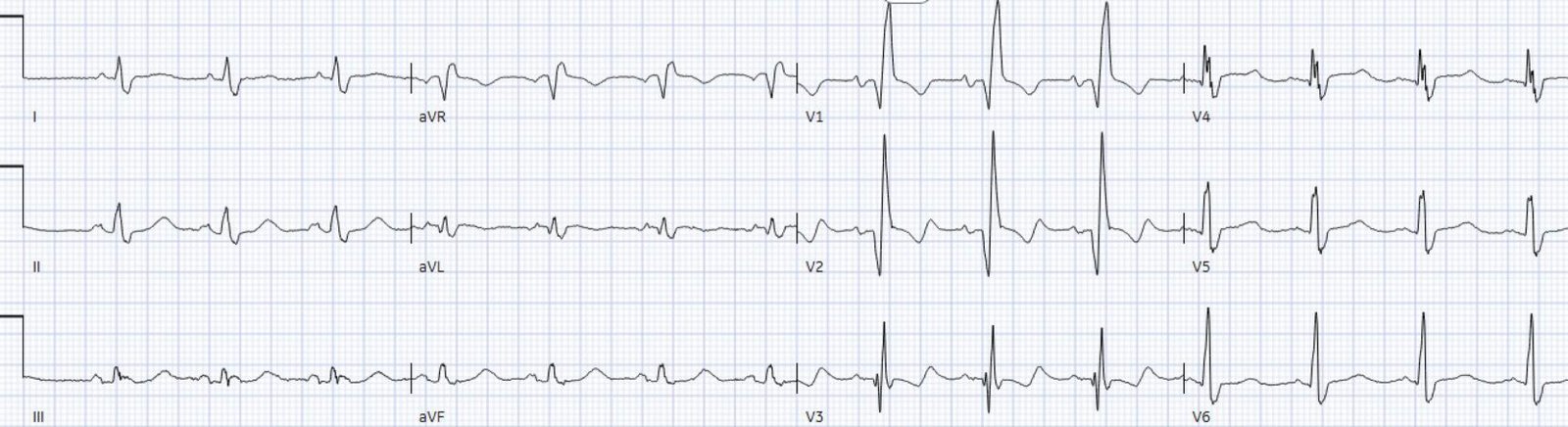 Chest pain with acute RBBB: just another NSTEMI? - Dr. Smith’s ECG Blog
