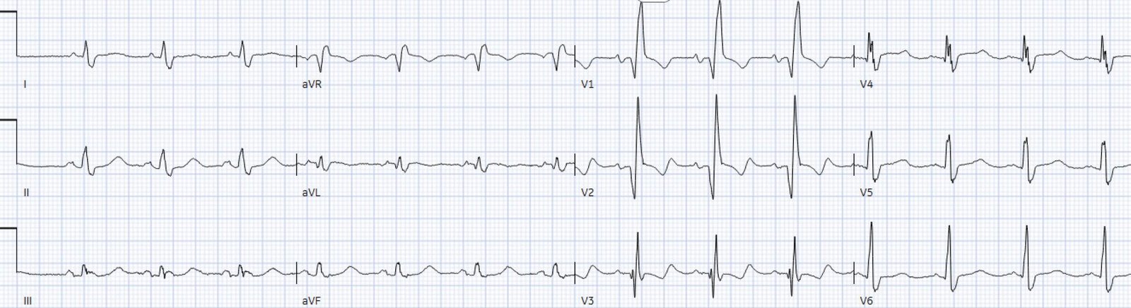 Chest pain with acute RBBB: just another NSTEMI? - Dr. Smith’s ECG Blog
