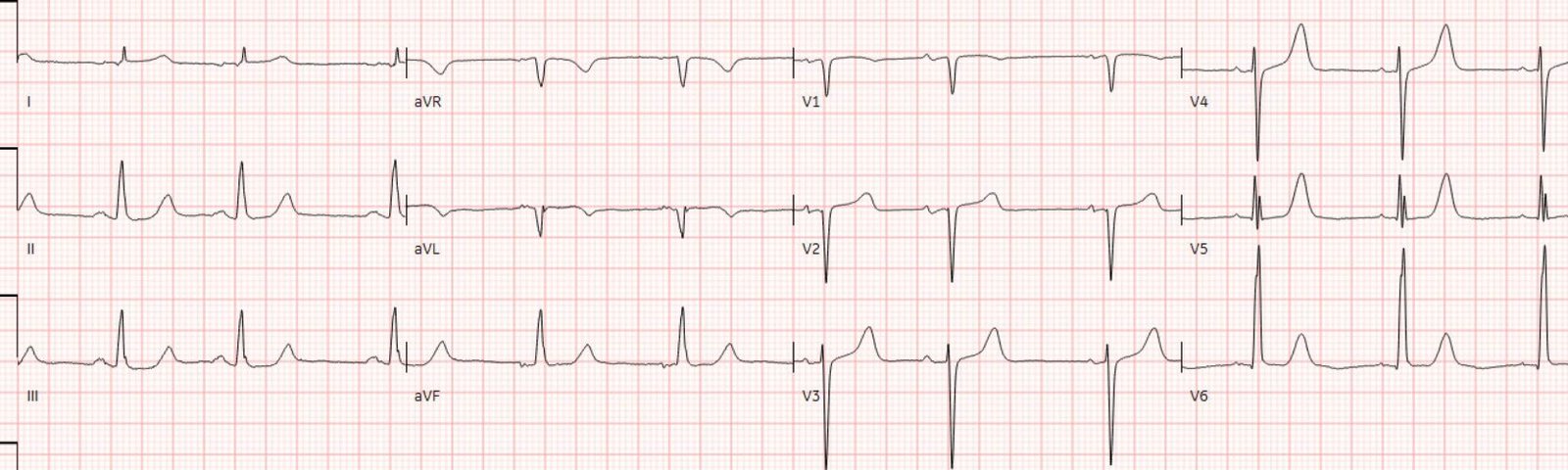 Chest pain with acute RBBB: just another NSTEMI? - Dr. Smith’s ECG Blog
