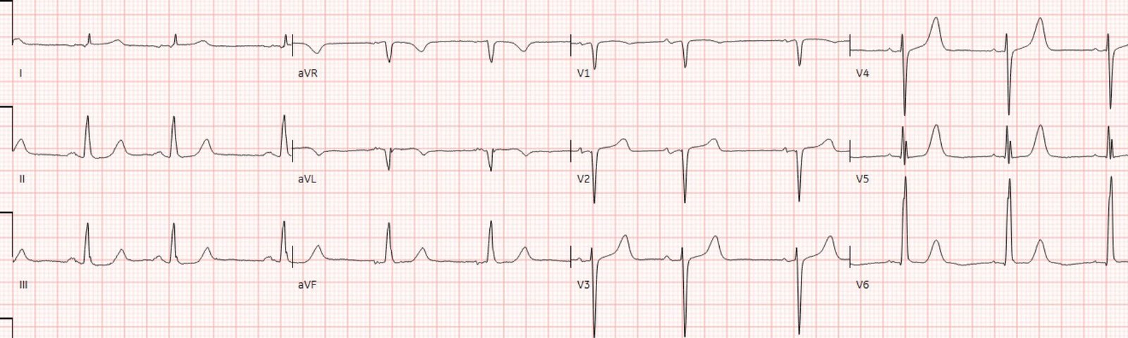 Chest pain with acute RBBB: just another NSTEMI? - Dr. Smith’s ECG Blog