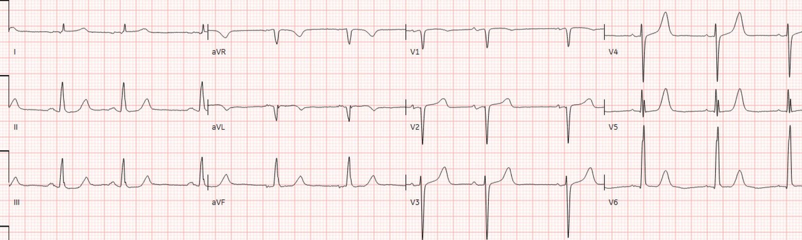 Chest pain with acute RBBB: just another NSTEMI? - Dr. Smith’s ECG Blog
