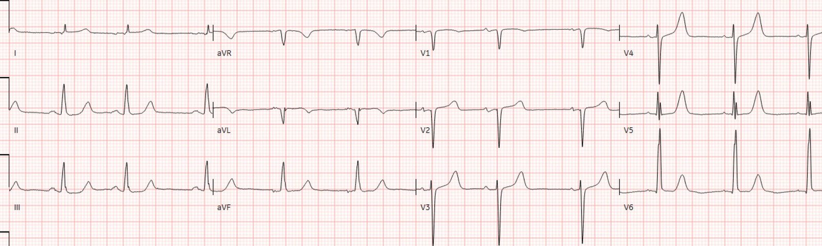 Chest pain with acute RBBB: just another NSTEMI? - Dr. Smith’s ECG Blog