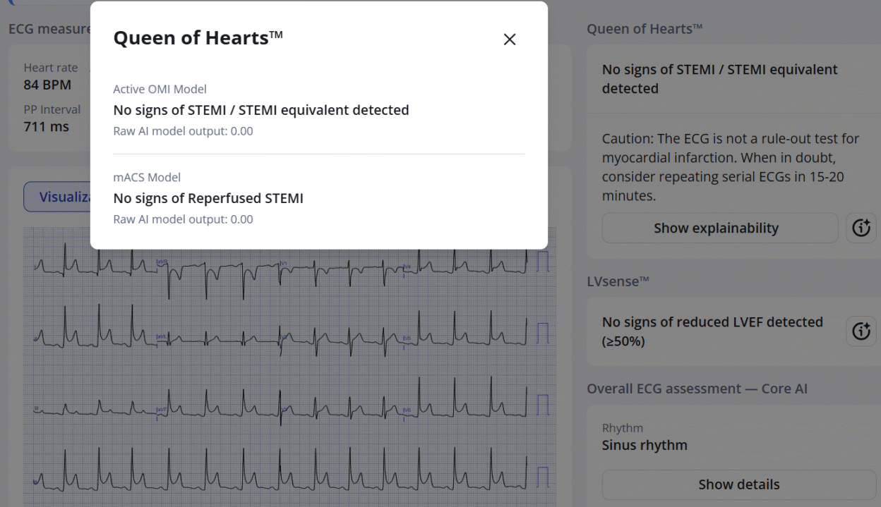 Acute Chest pain, 2 years in a row. - Dr. Smith’s ECG Blog