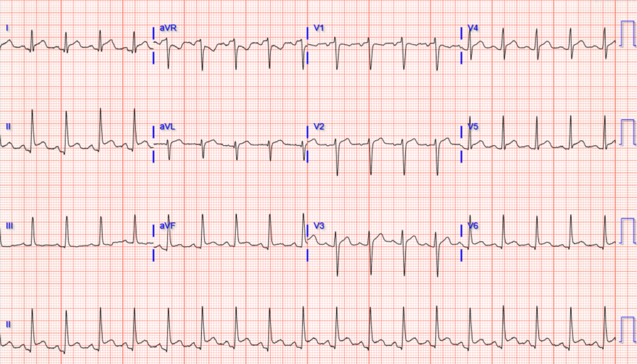 Acute Chest pain, 2 years in a row. - Dr. Smith’s ECG Blog