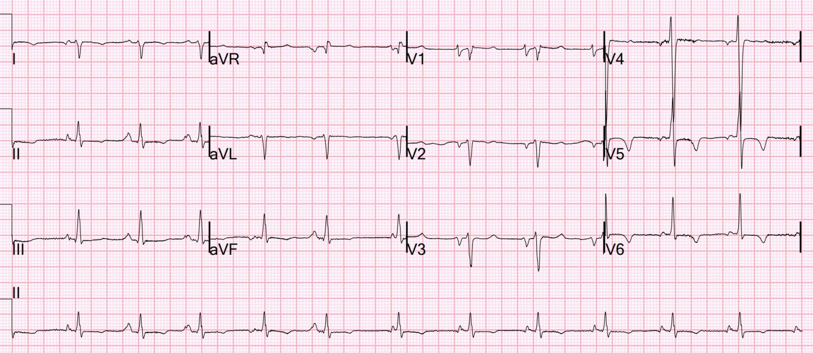 Several days of Shortness of breath. Other than the obvious atrial ...