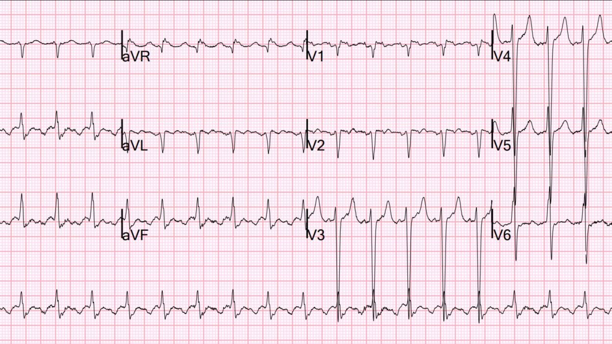 Increasing ST elevation. STEMI vs. dynamic early repolarization vs ...