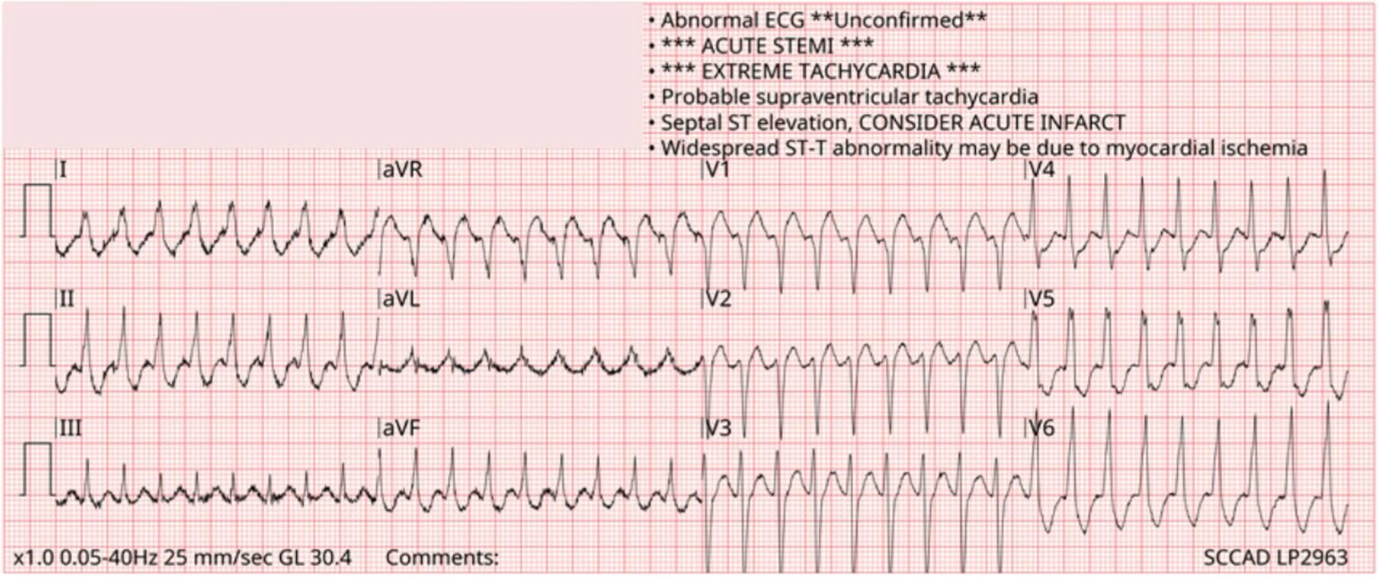 Rapid SVT, diagnosis? - Dr. Smith’s ECG Blog