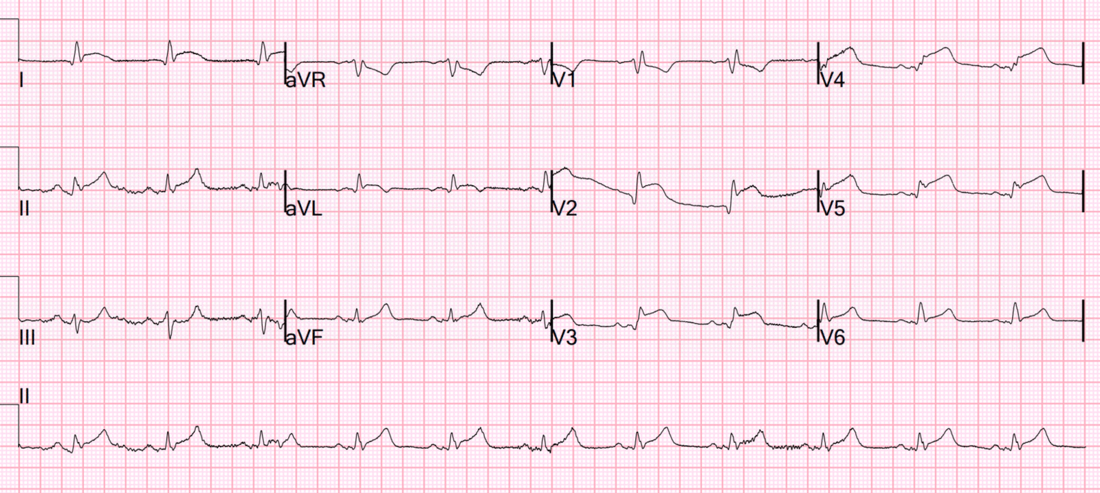 A very elderly woman with sudden severe chest pain radiating to her ...