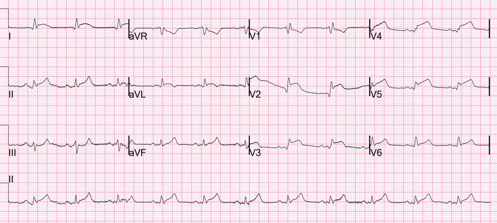A very elderly woman with sudden severe chest pain radiating to her ...