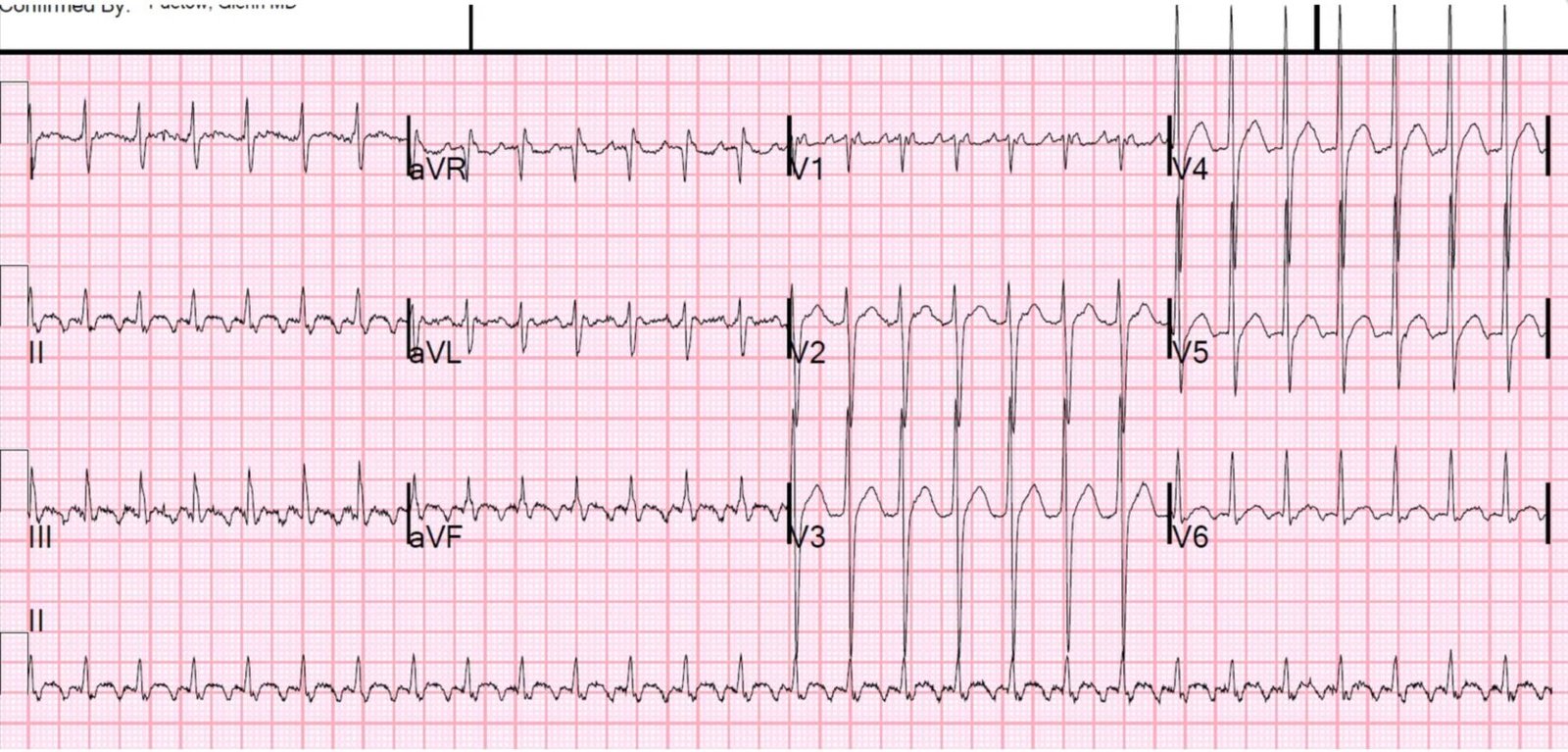 Rapid SVT, diagnosis? - Dr. Smith’s ECG Blog