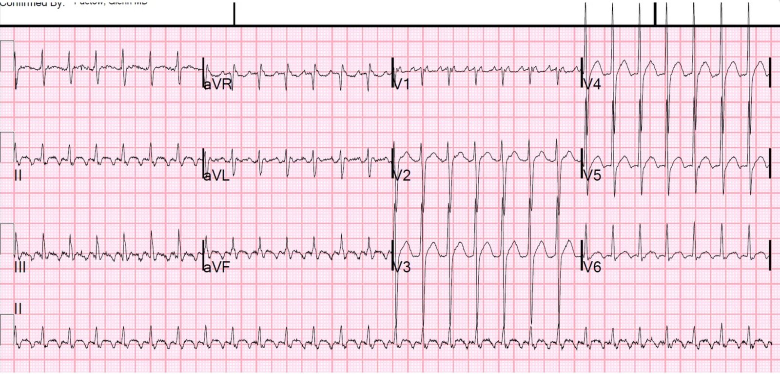 Rapid SVT, diagnosis? - Dr. Smith’s ECG Blog