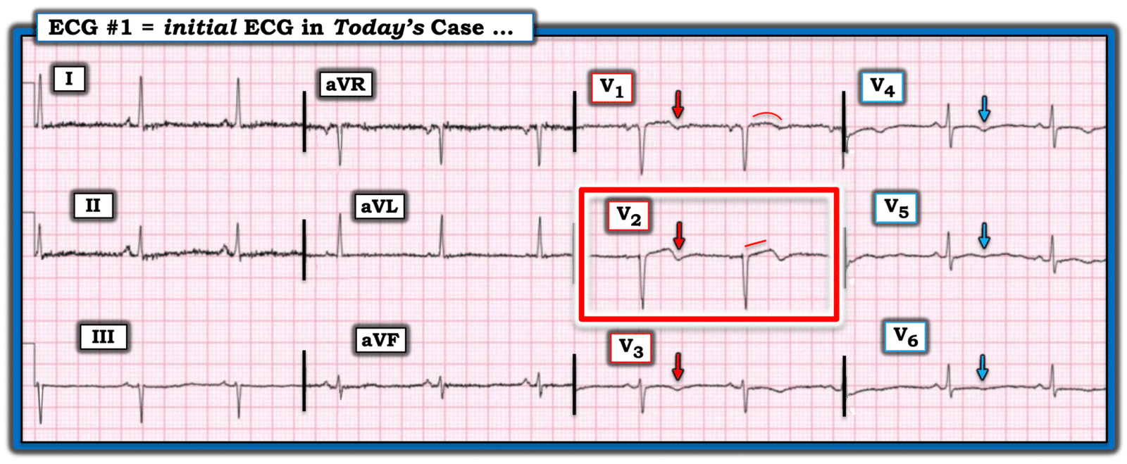 Severe chest pain, resolved. Serial troponins nearly undetectable at 3 ...