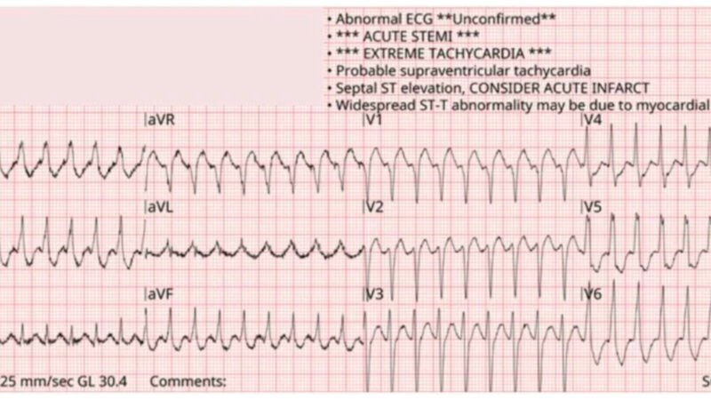 Rapid SVT, diagnosis? - Dr. Smith’s ECG Blog