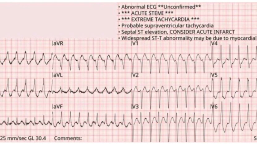 Supraventricular Tachycardia (PSVT) Archives - Dr. Smith’s ECG Blog