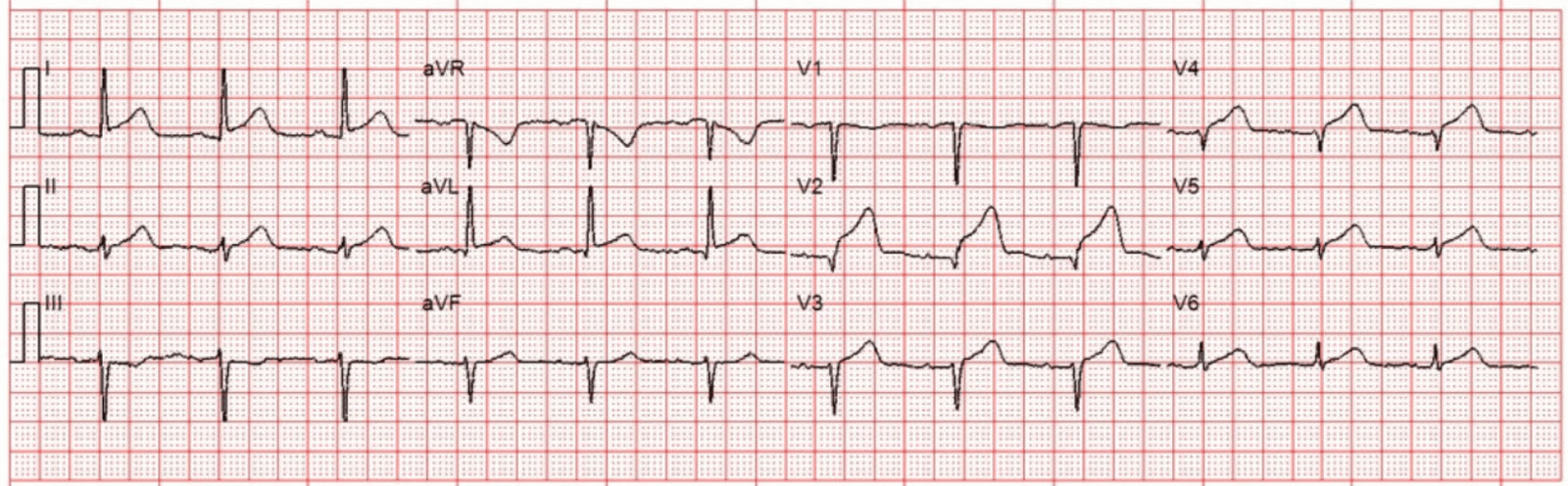 Found down, CPR, pulse regained. Here is the ED ECG. What is it? - Dr ...