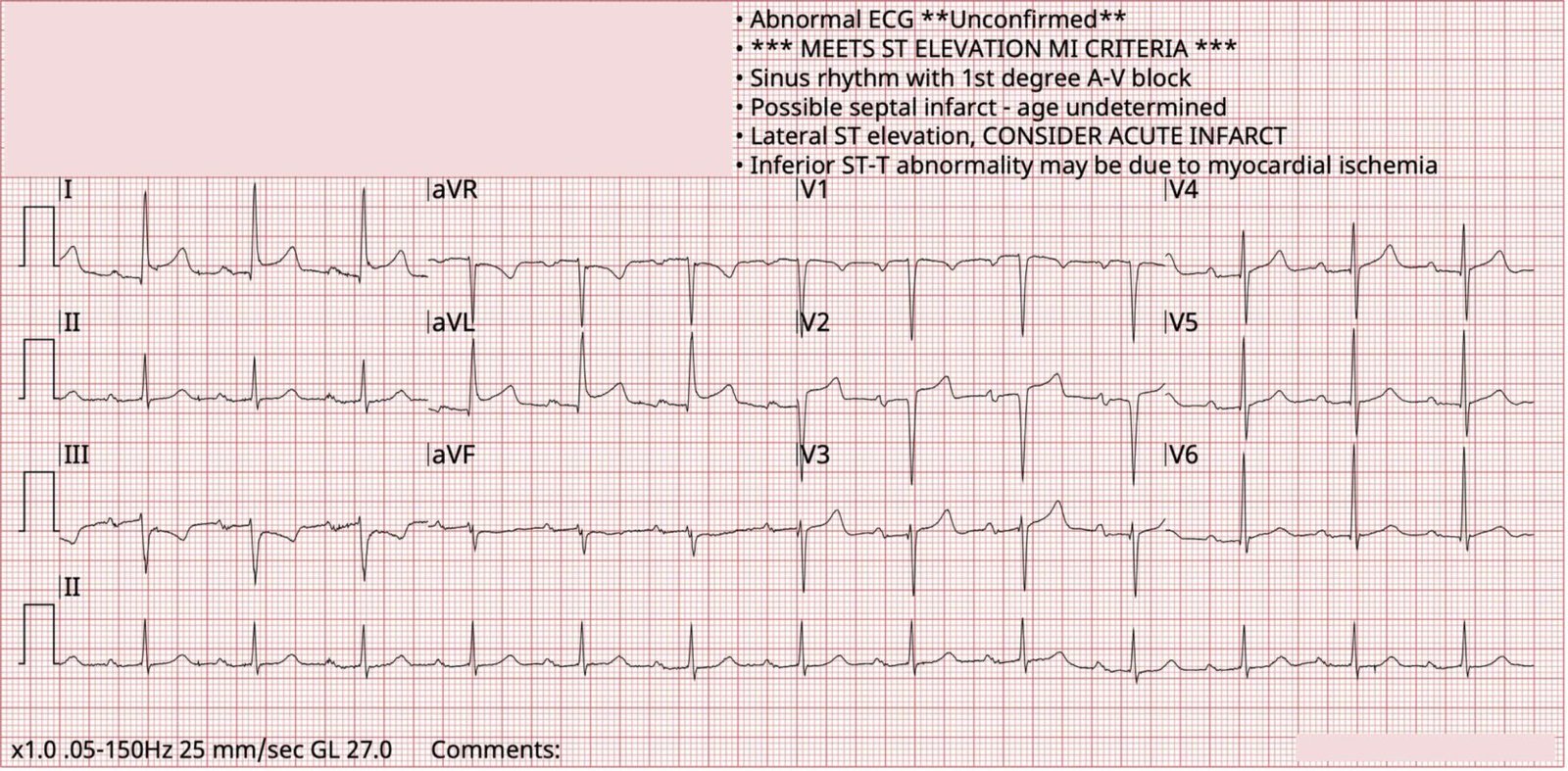 Found down, CPR, pulse regained. Here is the ED ECG. What is it? - Dr ...