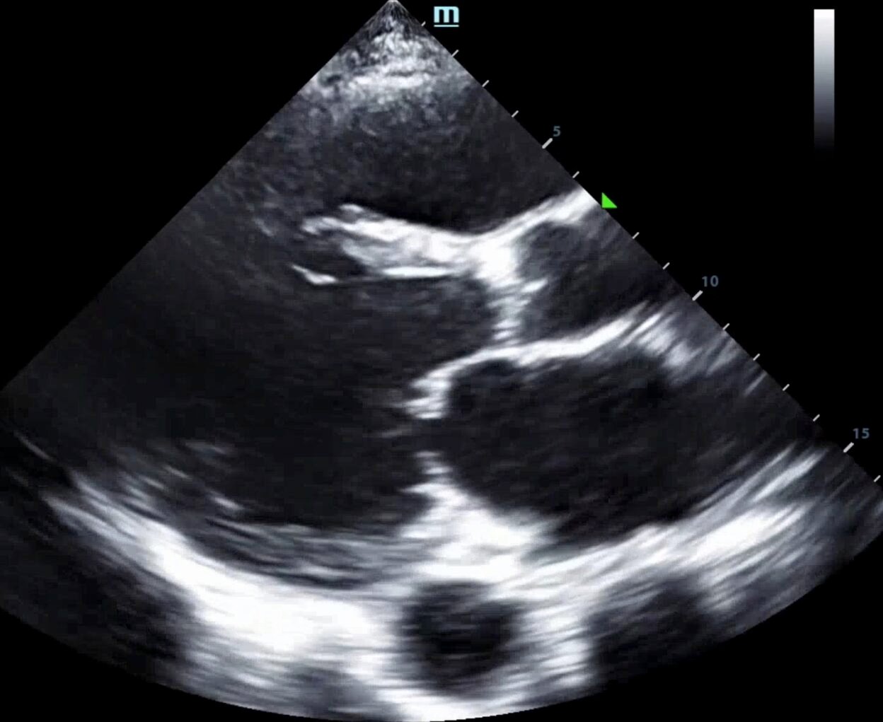 Several days of Shortness of breath. Other than the obvious atrial ...