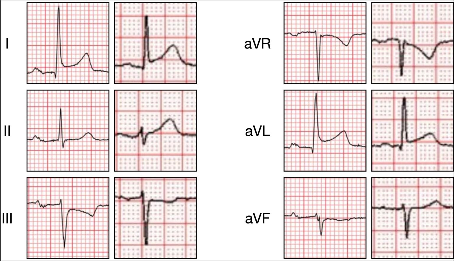 Found down, CPR, pulse regained. Here is the ED ECG. What is it? - Dr ...