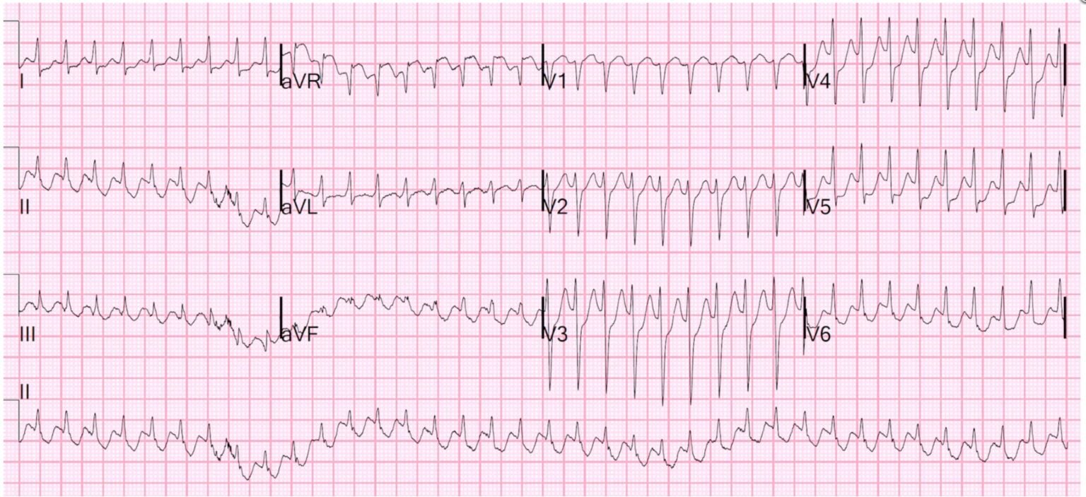 Rapid SVT, diagnosis? - Dr. Smith’s ECG Blog