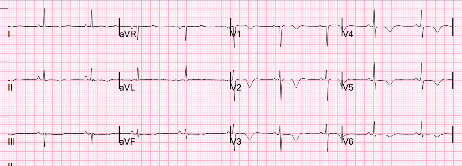 Severe chest pain, resolved. Serial troponins nearly undetectable at 3 ...