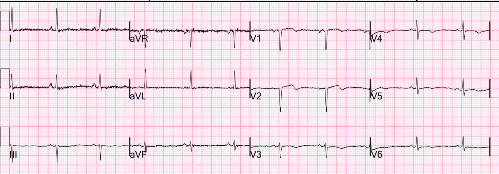 Severe chest pain, resolved. Serial troponins nearly undetectable at 3 ...