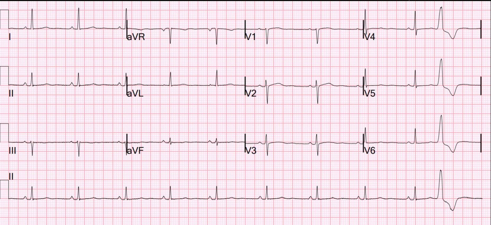 Severe chest pain, resolved. Serial troponins nearly undetectable at 3 ...