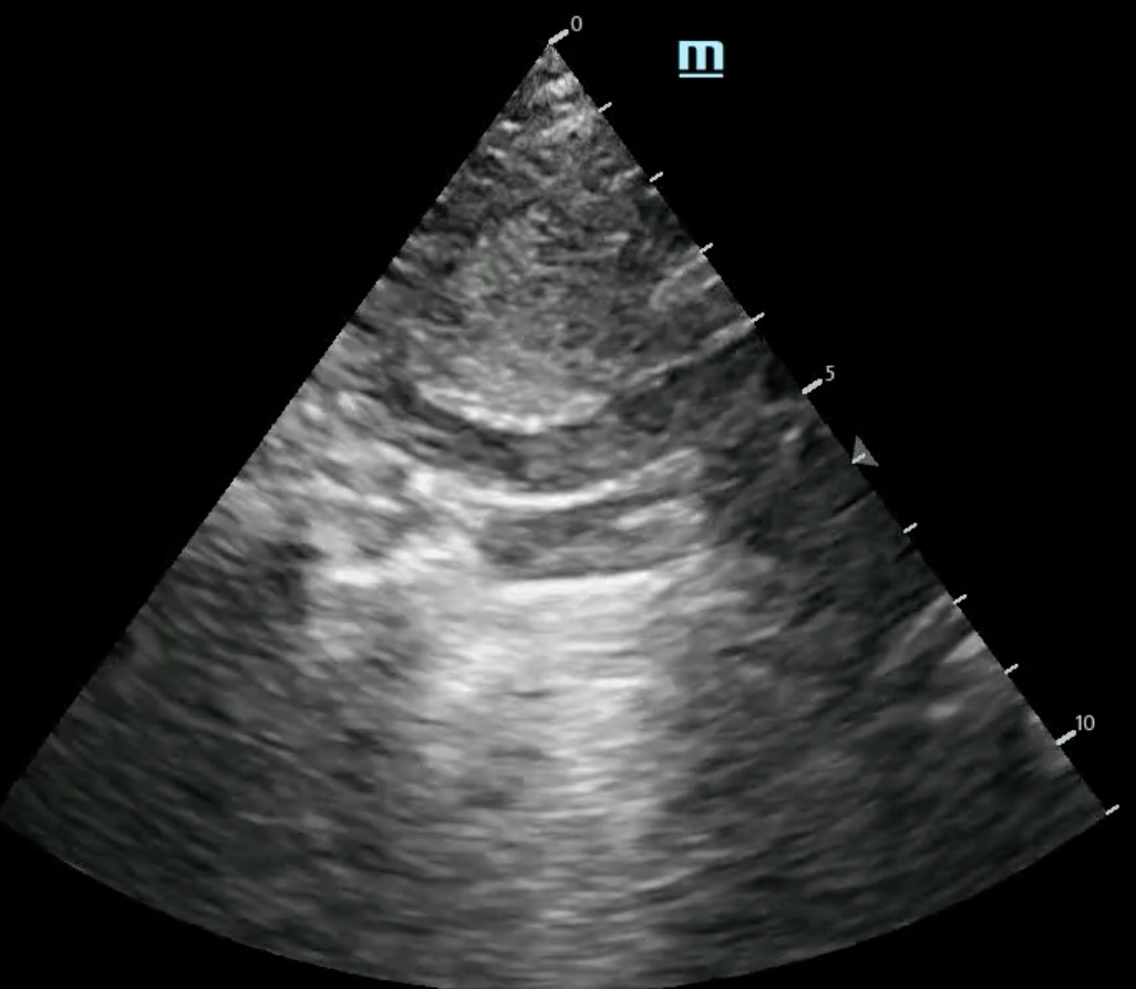A very elderly woman with sudden severe chest pain radiating to her ...