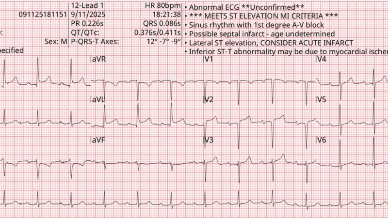 Sinus rhythm with a new wide complex QRS - Dr. Smith’s ECG Blog