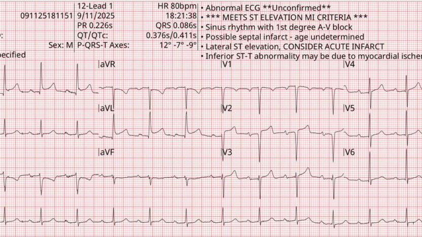 Sinus rhythm with a new wide complex QRS - Dr. Smith’s ECG Blog