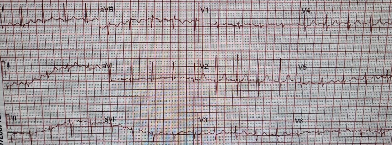 Chest pain in a rural hospital: is this pericarditis or does the ...
