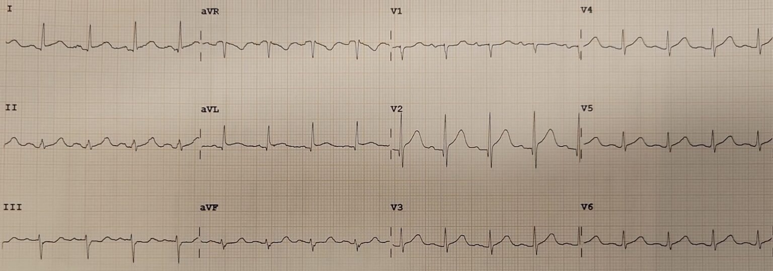 Chest pain in a rural hospital: is this pericarditis or does the ...
