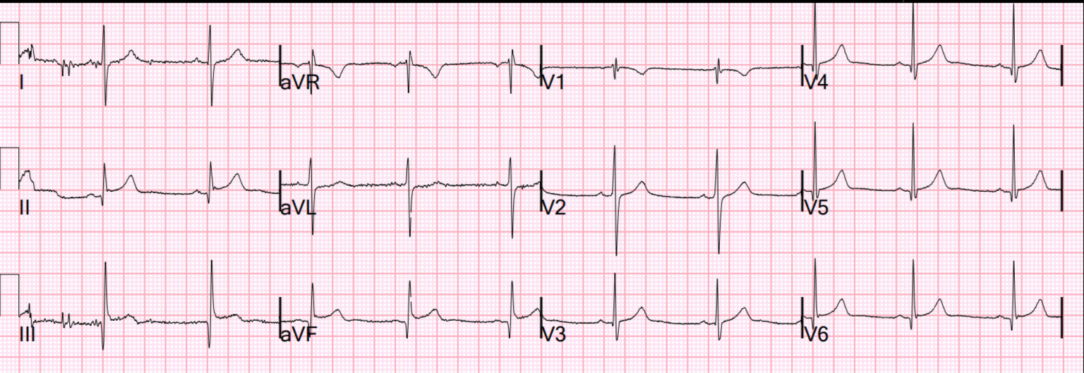 Worrisome chest pain and inferior ST Elevation - Dr. Smith’s ECG Blog