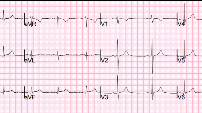 Steve Smith, Author at Dr. Smith’s ECG Blog