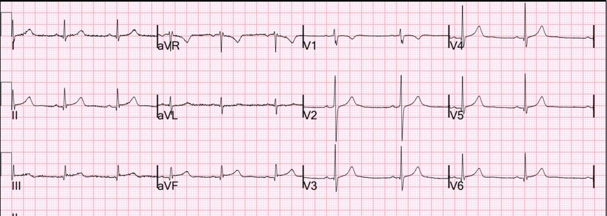 Worrisome chest pain and inferior ST Elevation - Dr. Smith’s ECG Blog