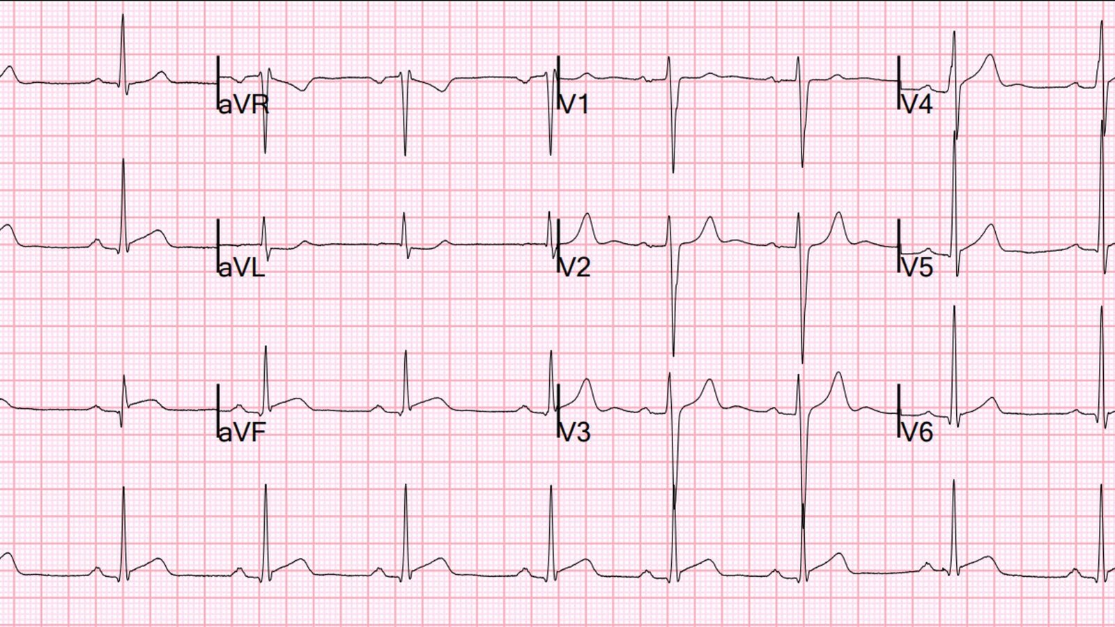 Steve Smith, Author at Dr. Smith’s ECG Blog